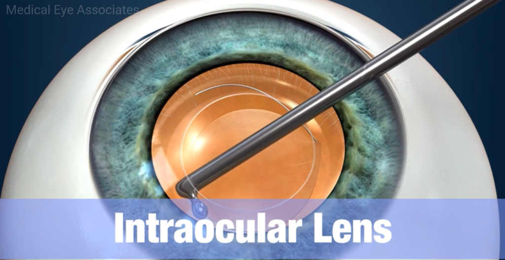 Replacing cataract with IOL (Intraocular Lens) during surgery - Medical ...